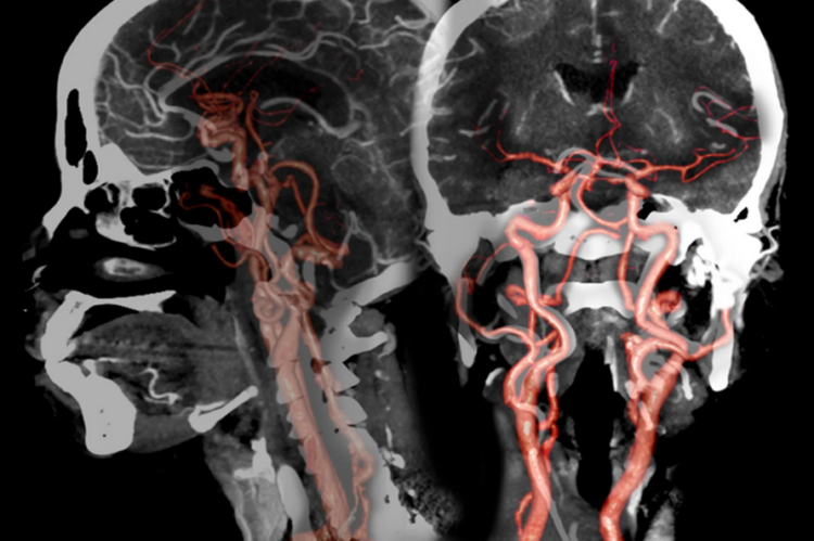 What is a CT Angiography (CTA) Scan? - 2024 Guide - Bel-India
