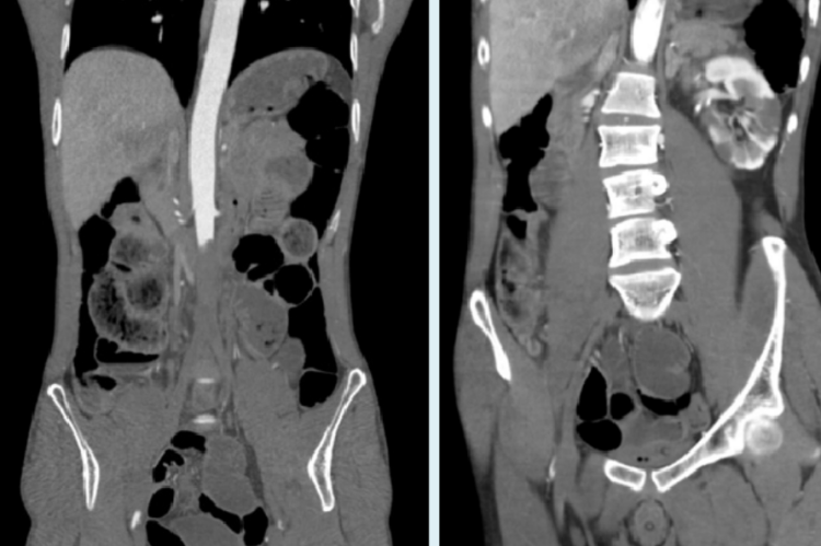 What is a CT Angiography (CTA) Scan? - 2024 Guide - Bel-India